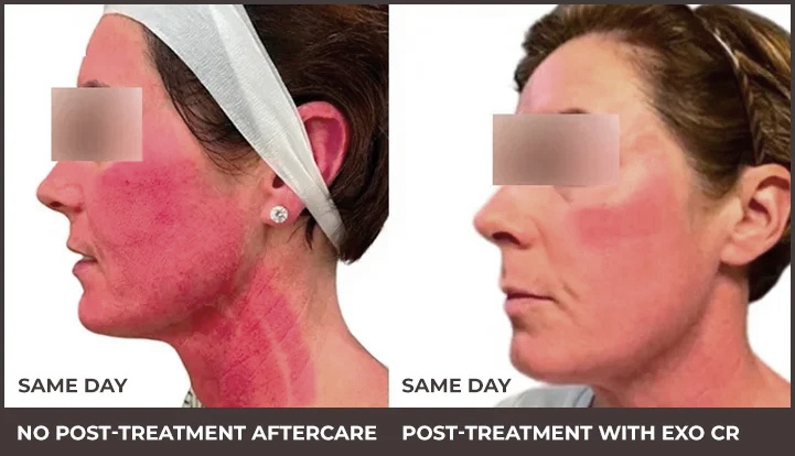 Chronos: The New Standard for Exosomes in Aesthetics